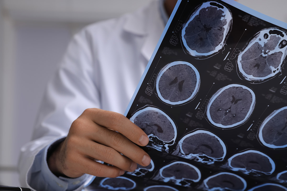 Assessing Concussion Severity: What You Need to Know Now
